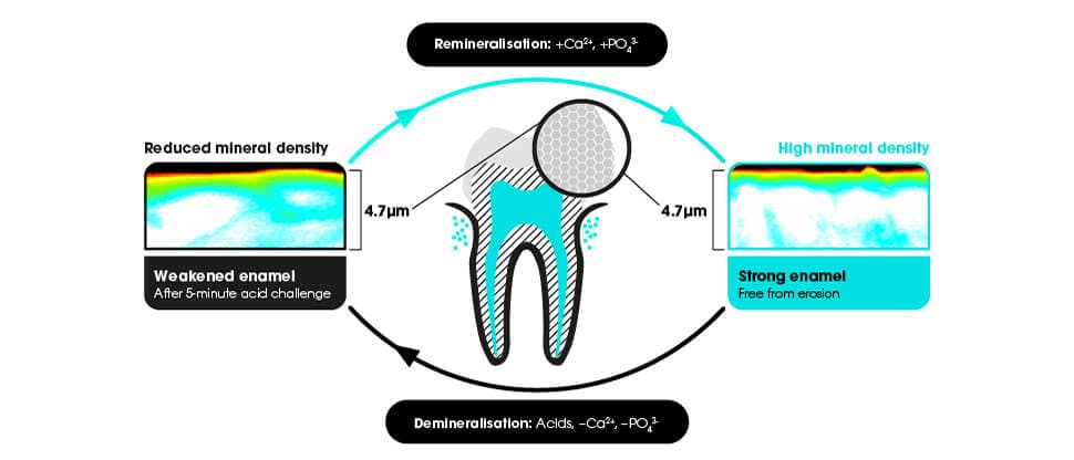 Erosive Tooth Wear - Causes & Mechanism | Haleon HealthPartner