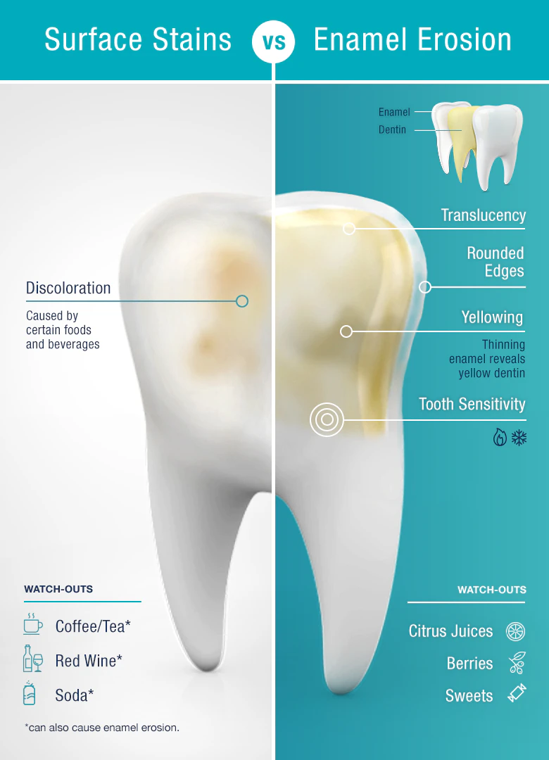 Veneers Enamel Erosion Veneers Enamel Erosion
