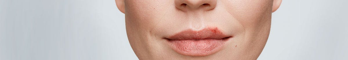 Cold Sore Stages Identification And Treatment Atelier Yuwaciaojp
